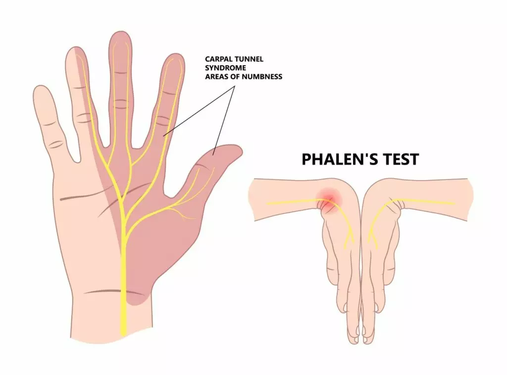Carpal Tunnel Test