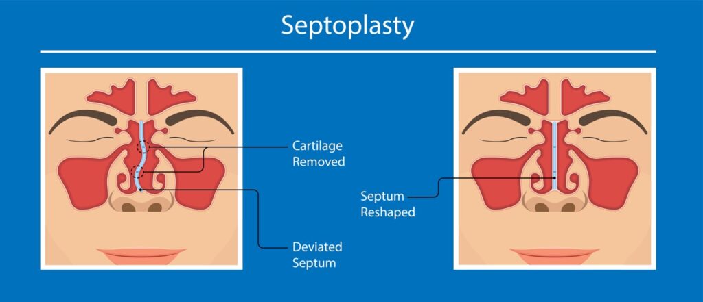 Deviated Nasal Septum Surgery | North Carolina Specialty Hospital