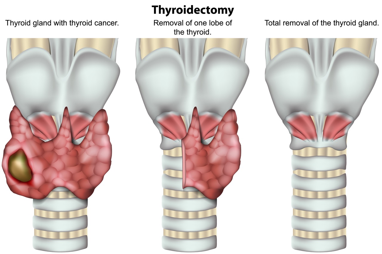 How Long Is the Recovery for Thyroid Surgery? | NCSH